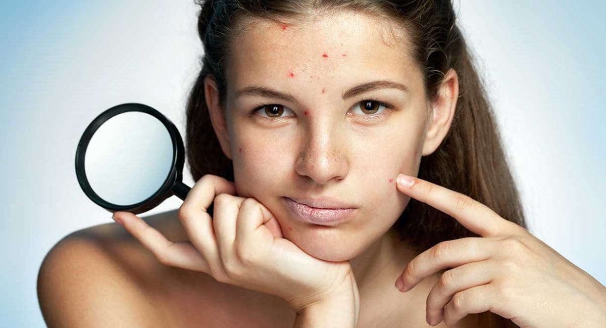 Acne - How To Treat Acne - Dr Sandra Cabot MD