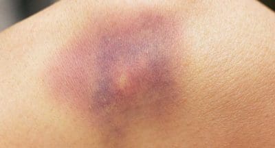 Bruising - Dr Sandra Cabot MD