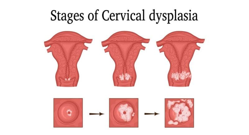Cervical Dysplasia Dr Sandra Cabot Md