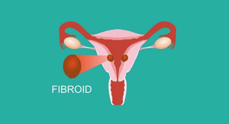 Fibroids - Dr Sandra Cabot MD