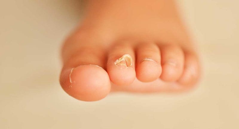 Fungal Toe Nails – A Safe Cure - Dr Sandra Cabot MD