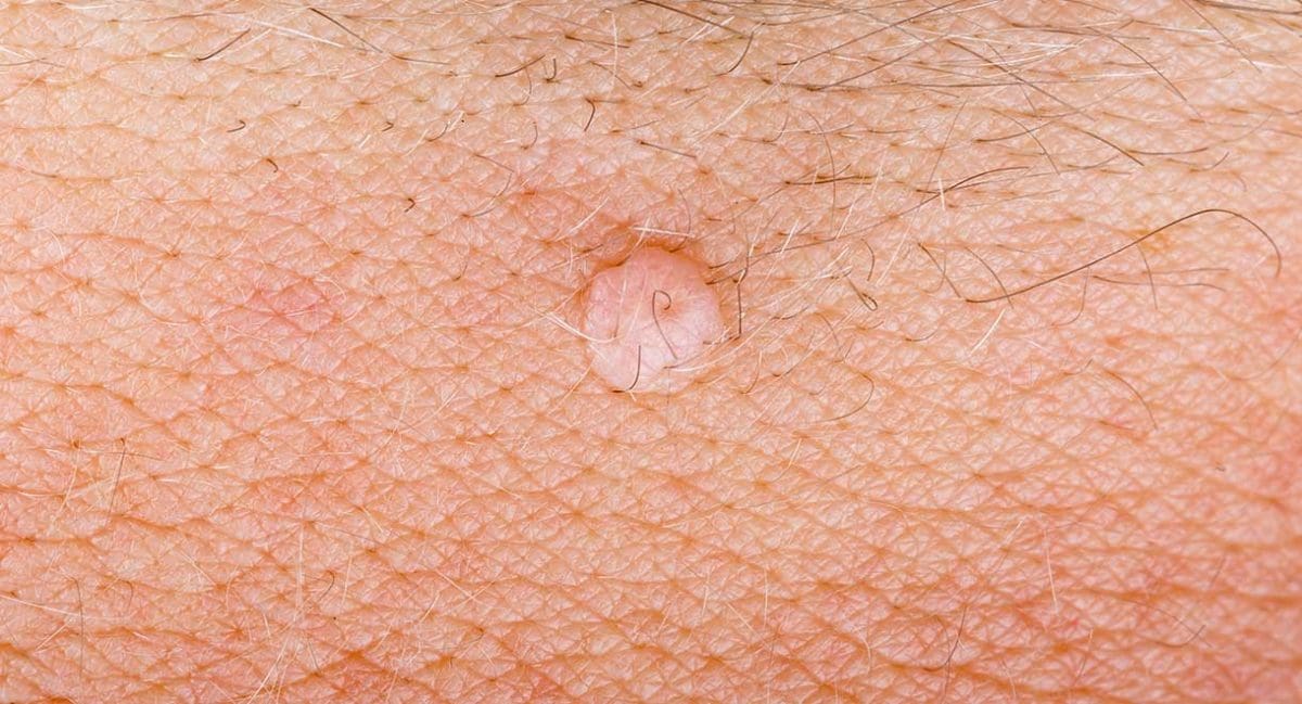 Warts - Dr Sandra Cabot MD