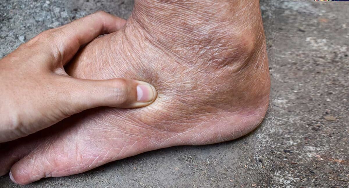 Fluid Retention - Dr Sandra Cabot MD